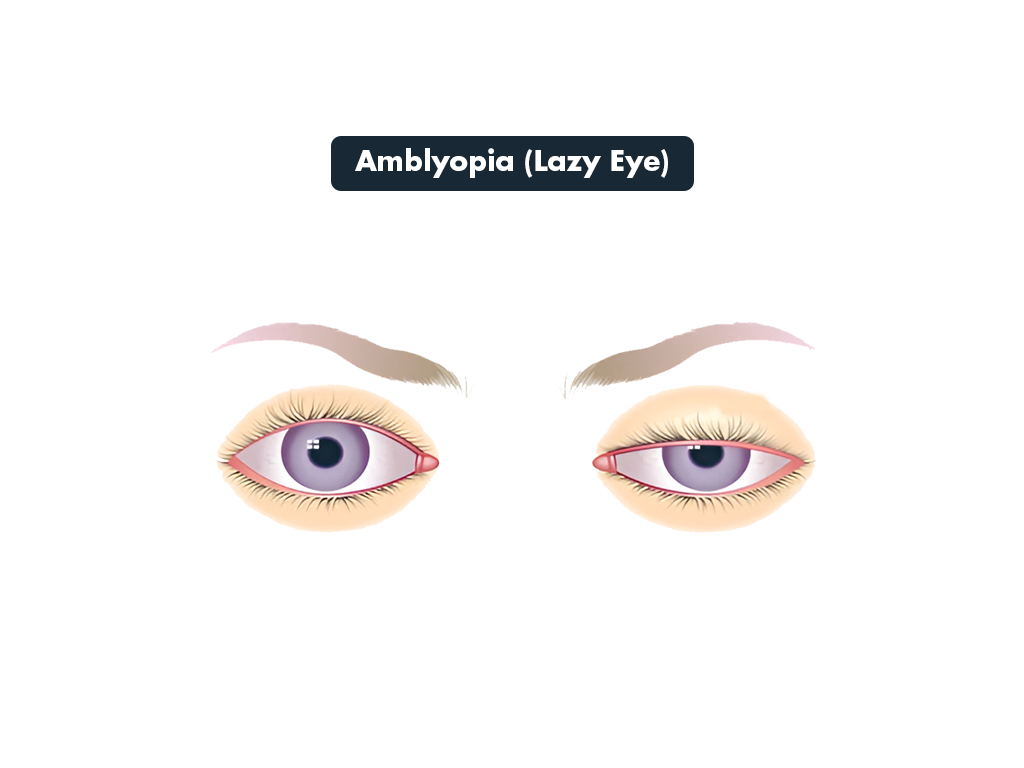 Common Childhood Eye Problems | Drishti Eye Care System