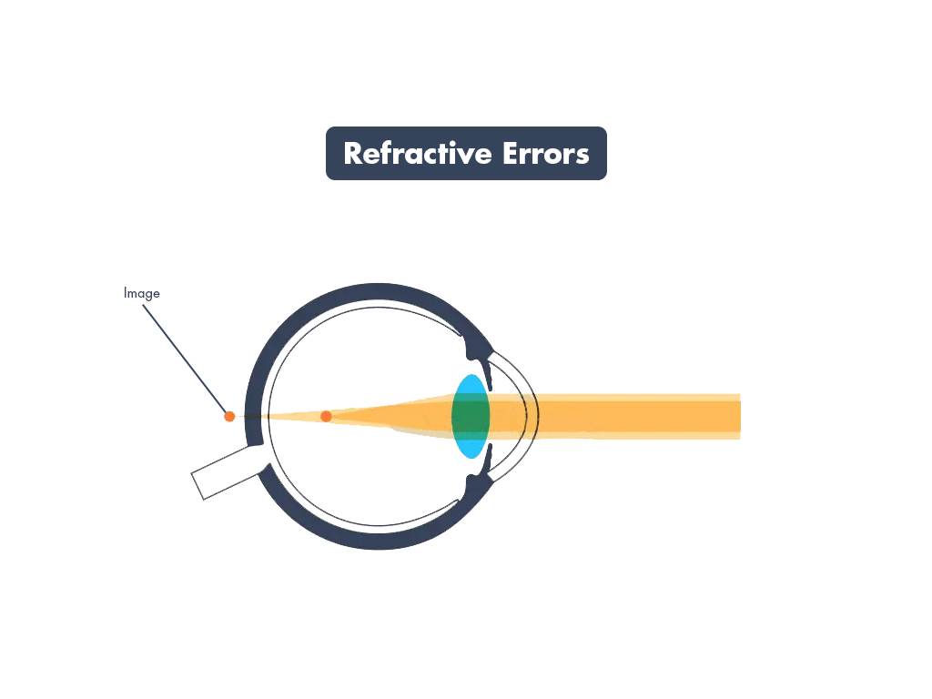 Common Childhood Eye Problems | Drishti Eye Care System